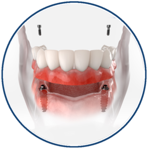 Dental Implant Options | St Louis, MO | New You Smile